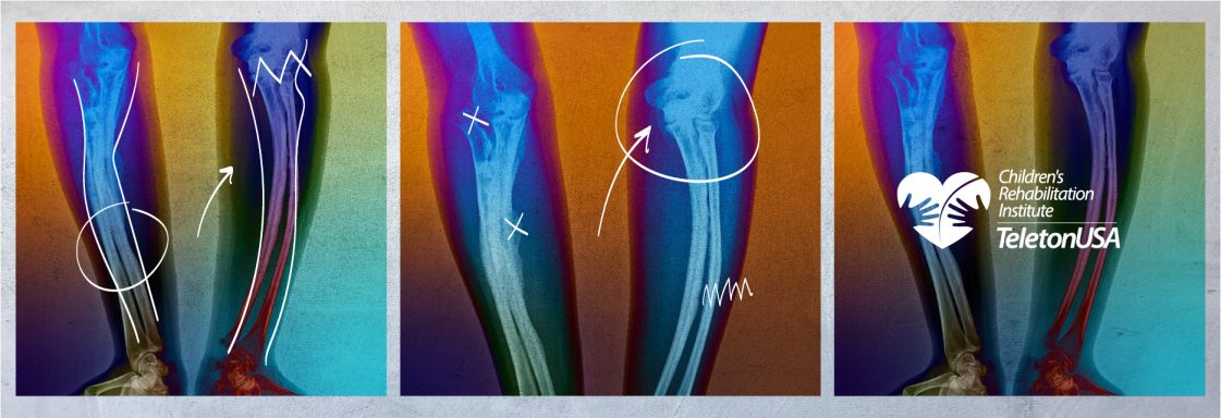 About OI: Types, Symptoms, and Treatment - Children's Rehabilitation ...